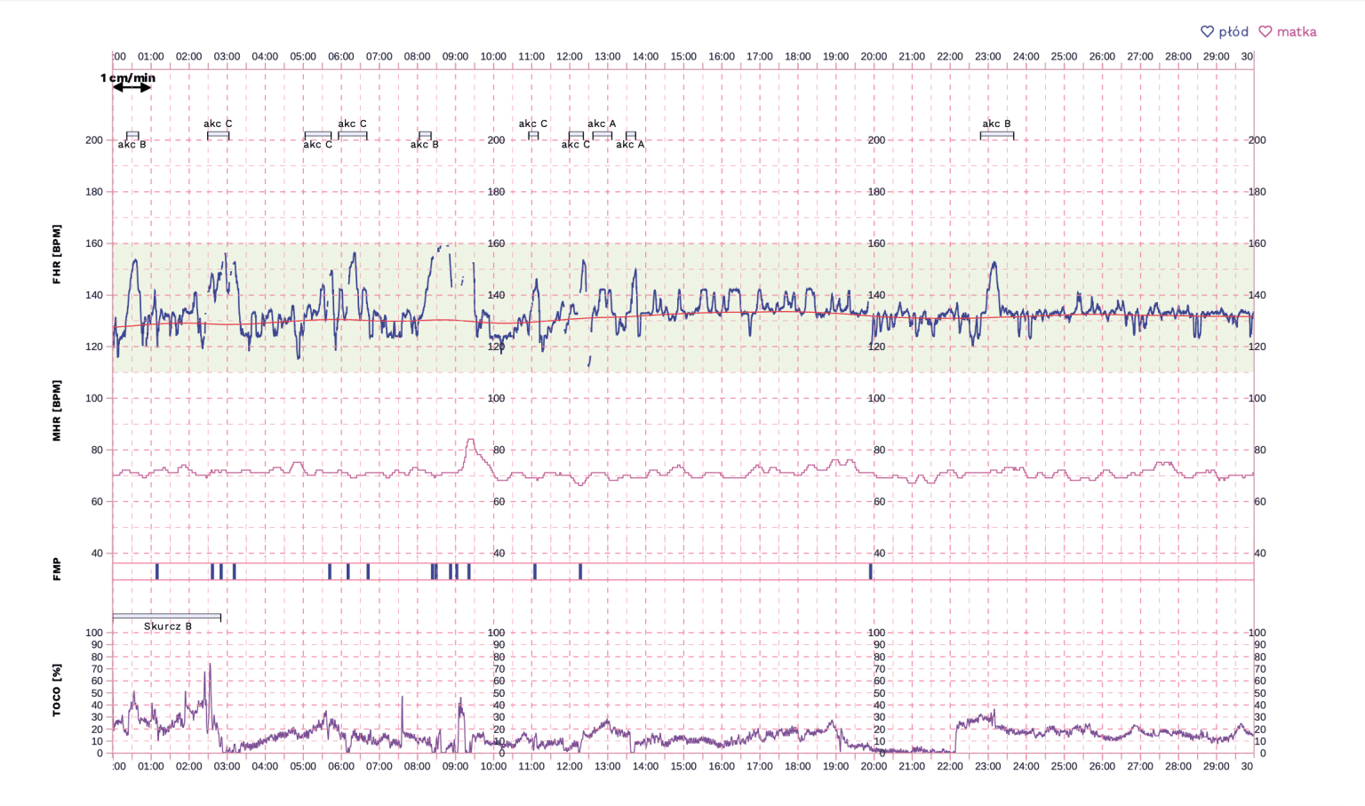 Jak odczytać zapis KTG? | TeleKTG