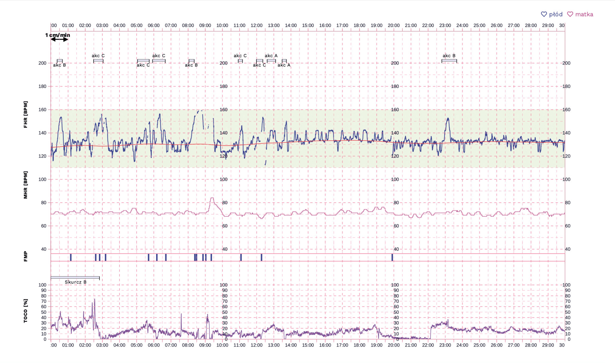 Jak odczytać zapis KTG? | TeleKTG